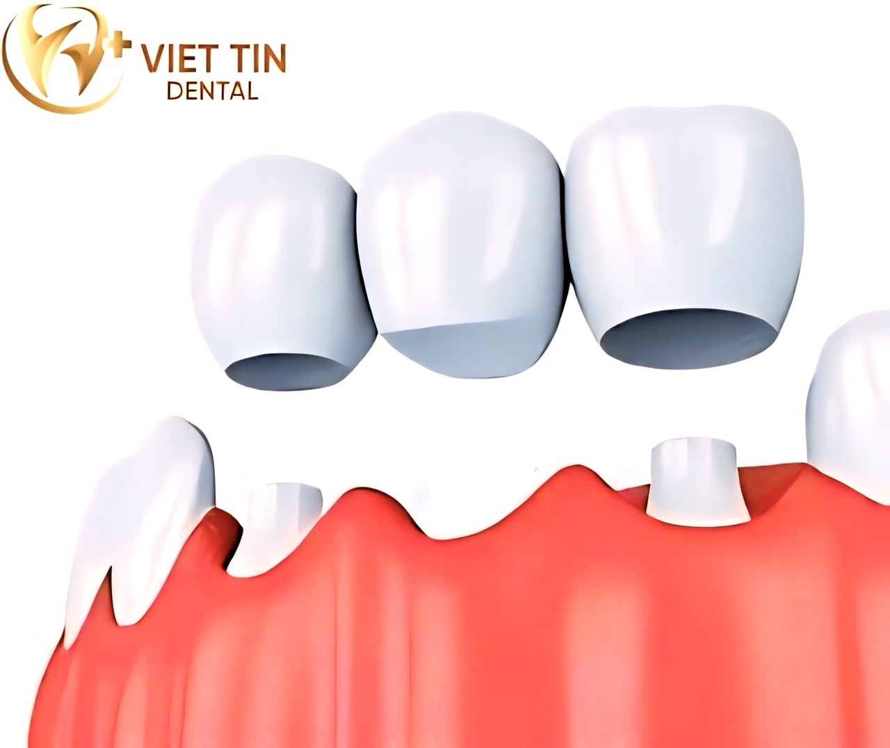 Cầu răng sứ là gì? Giá làm cầu răng sứ? Có tuổi thọ bao lâu?